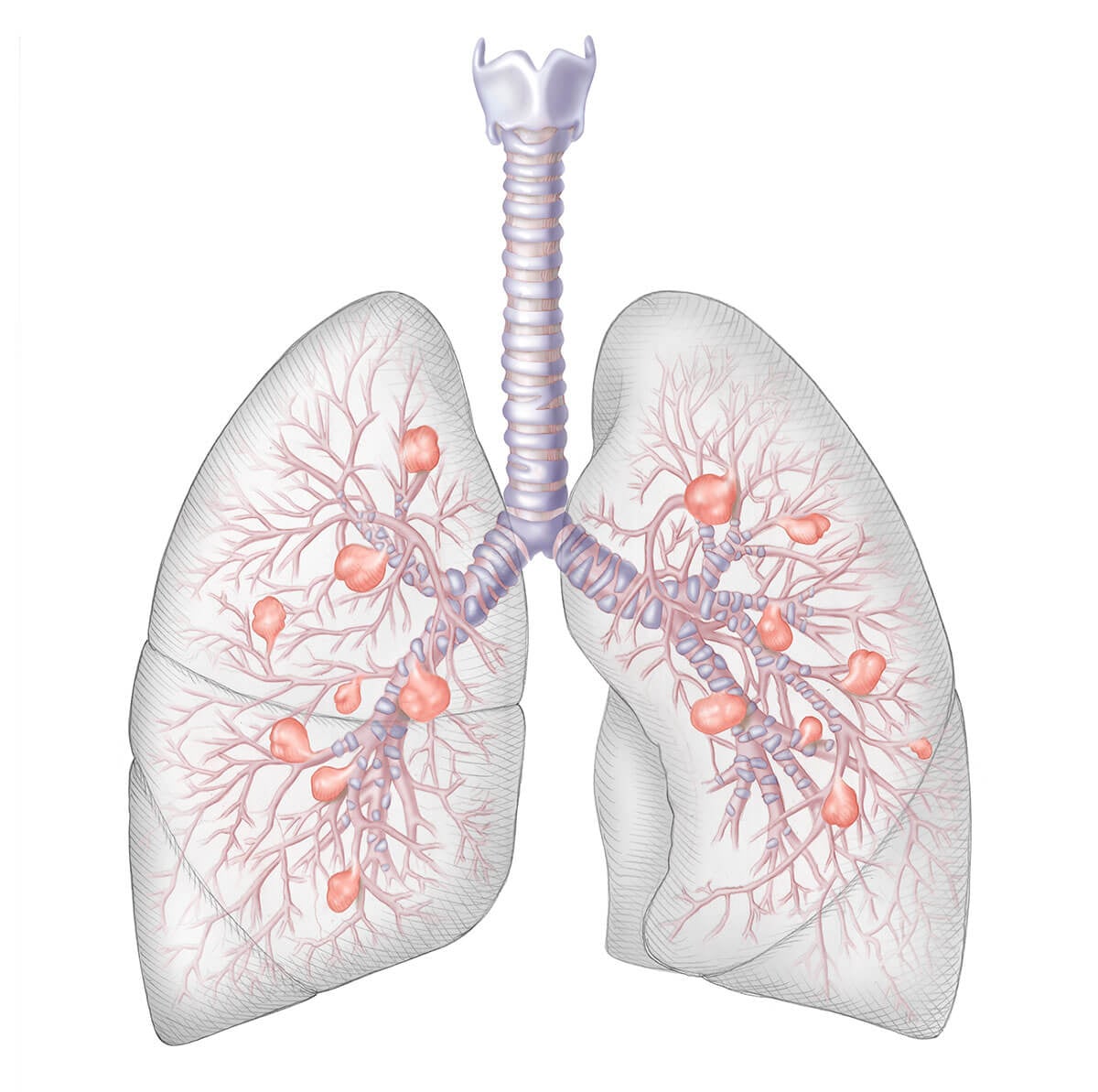 Bronkiektasi - Utvidelser av luftveienes bronkier | LHL